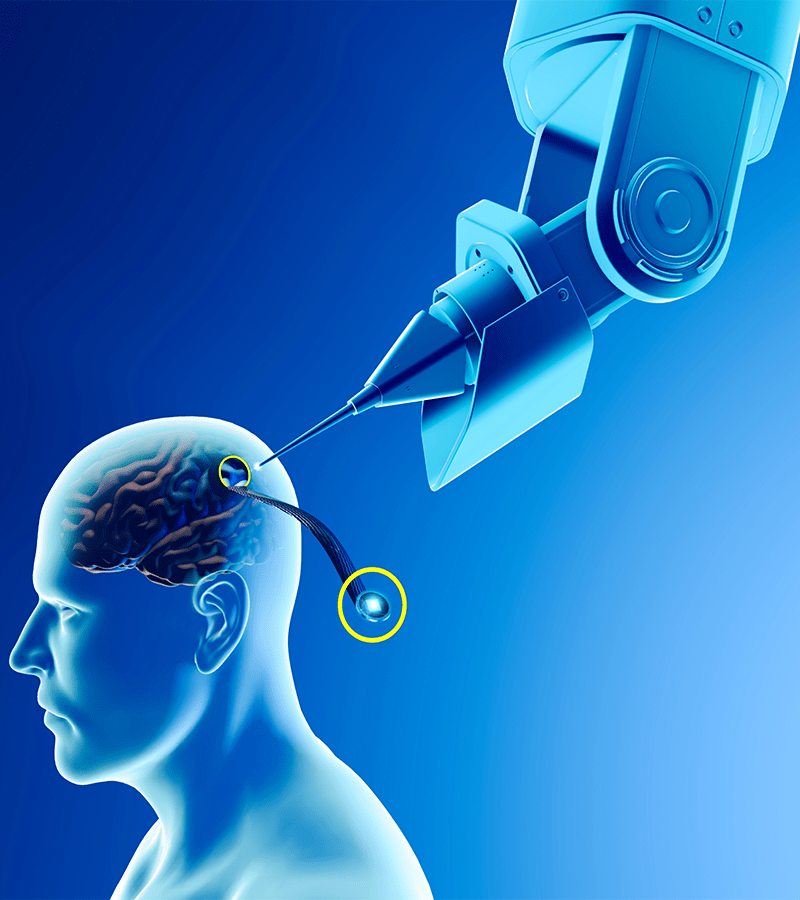 Les puces cérébrales Neuralink d’Elon Musk seront testées dès 2022 - BTLV